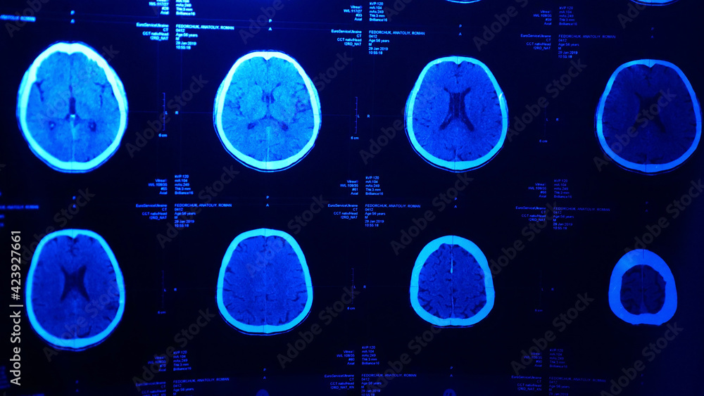 This stock photo shows a magnetic resonance imaging MRI of the brain ...