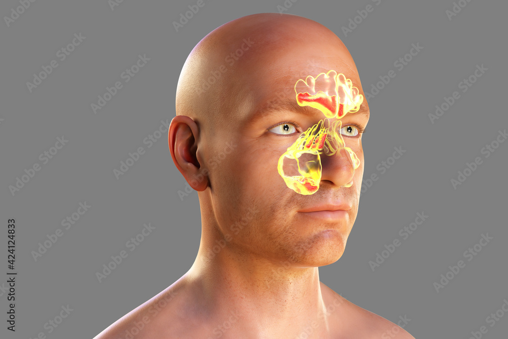 Purulent inflammation of frontal, maxillary and ethmoid sinuses in a ...