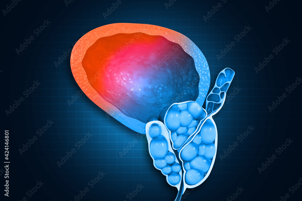 Bladder stones. Cross section. 3d illustration Stock Illustration ...