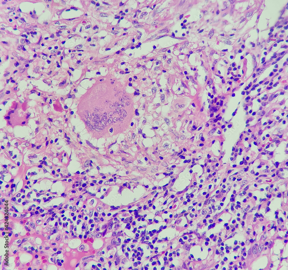 Foto de Photo of granuloma with multinucleated giant histiocytes ...