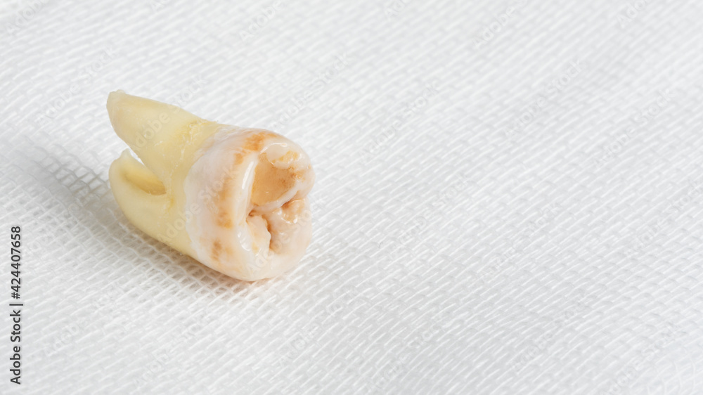 Pulled out wisdom tooth with filling and caries on white cheesecloth ...