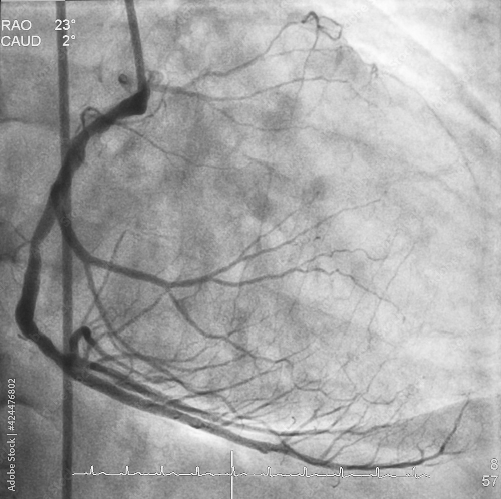 Coronary angiogram (CAG) was performed right coronary artery (RCA ...