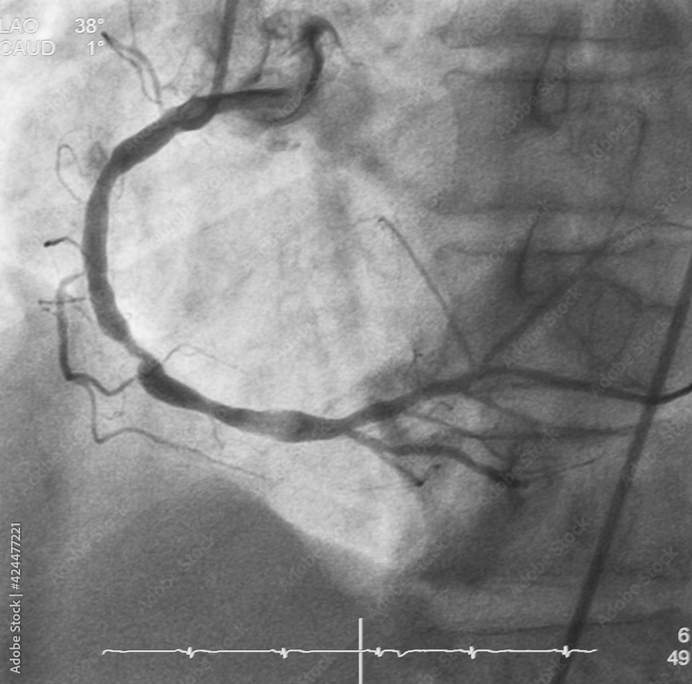 Coronary angiogram (CAG) was performed right coronary artery (RCA ...