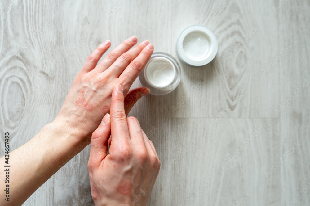Women's hands smeared with cream. Dermatitis on the hands. Dermatitis ...