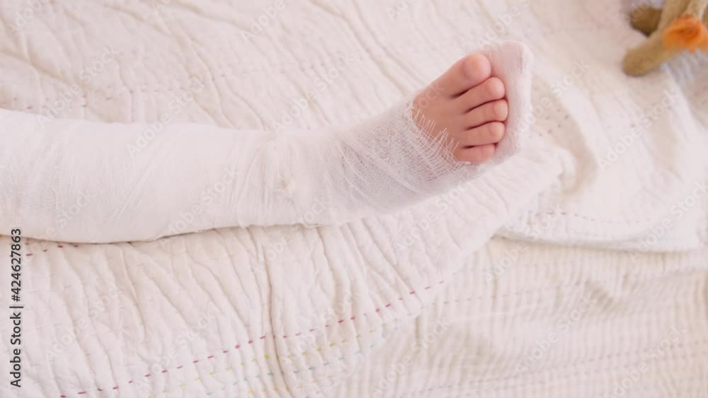 broken leg. Close-up of the cast on the feet. exercises to repair and ...
