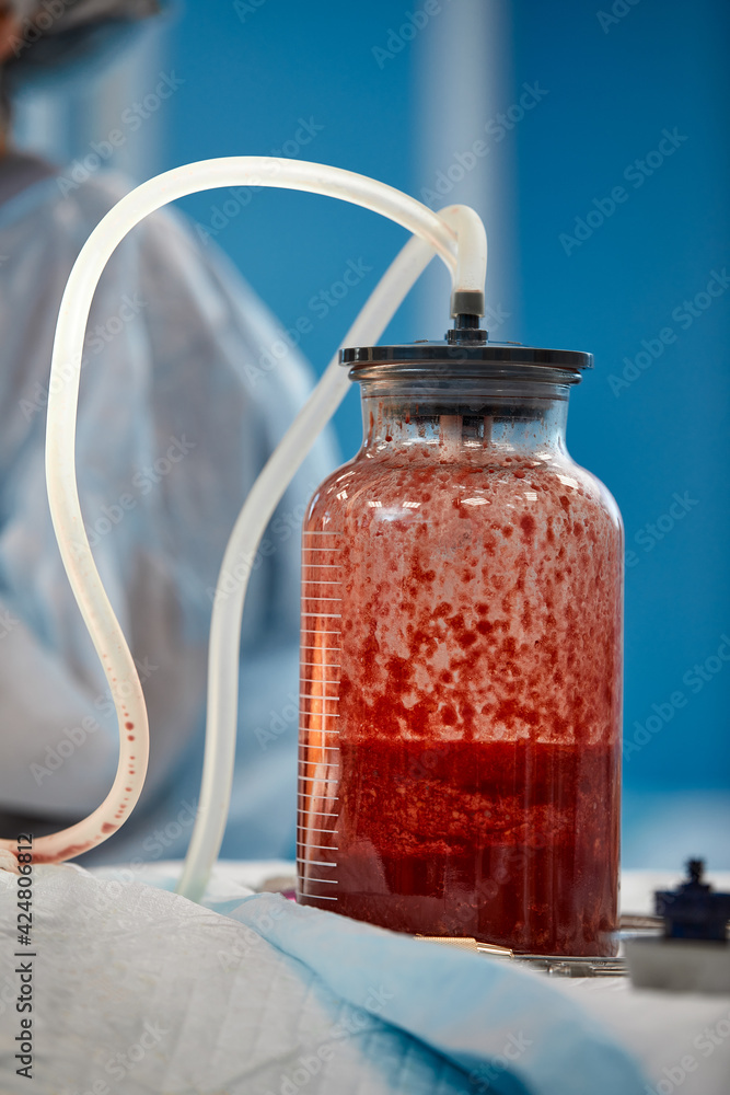 Plastic surgery to remove excess fat. Pumping fat into a jar during ...