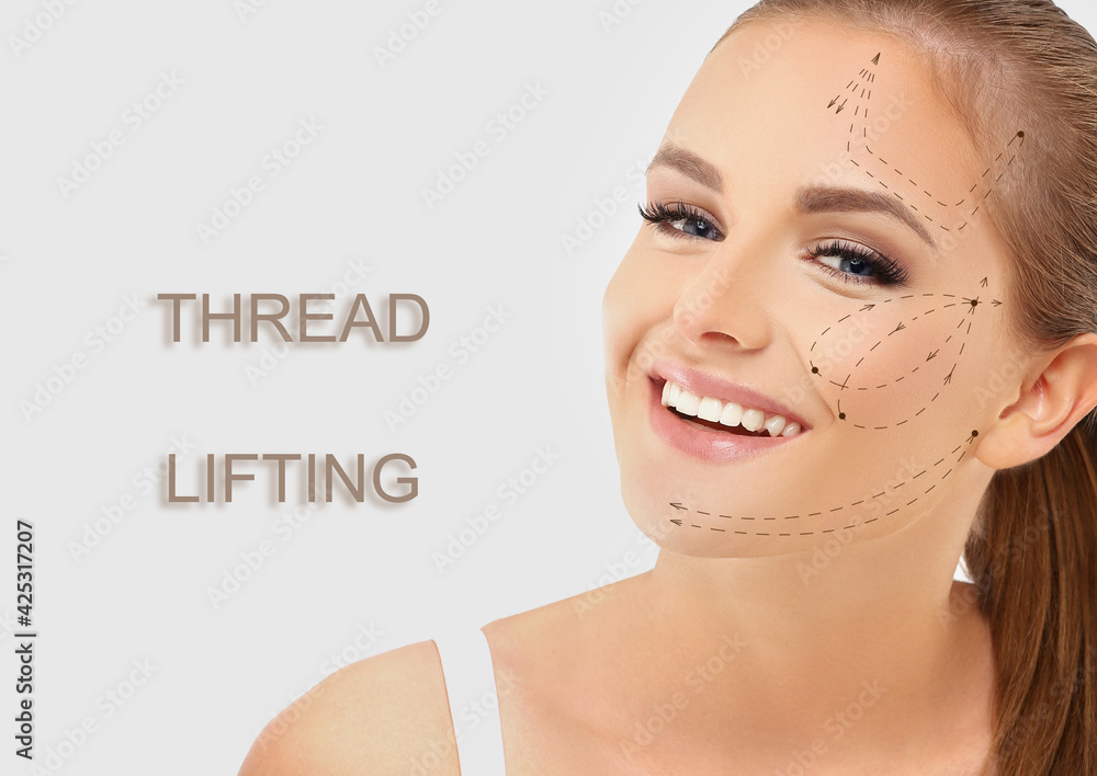 Thread Lift ,markup, thread-lift procedure for facial rejuvenation ...