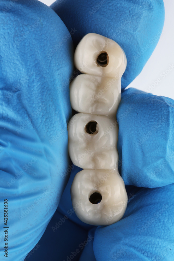 dental bridge for four teeth made of plastic in the doctor's hand on a ...