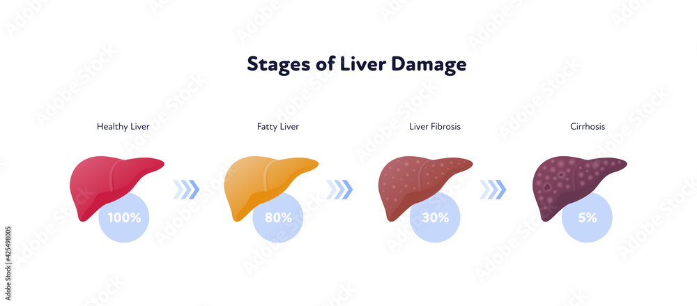 Liver damage infographic. Vector flat illustration. Anatomical human ...