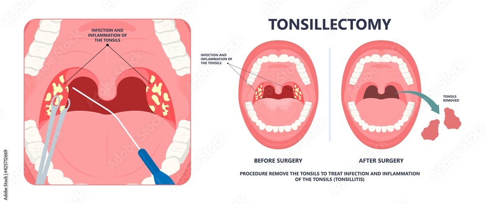 Vecteur Stock Tonsil Stones crypts viral virus gland strep throat sore ...