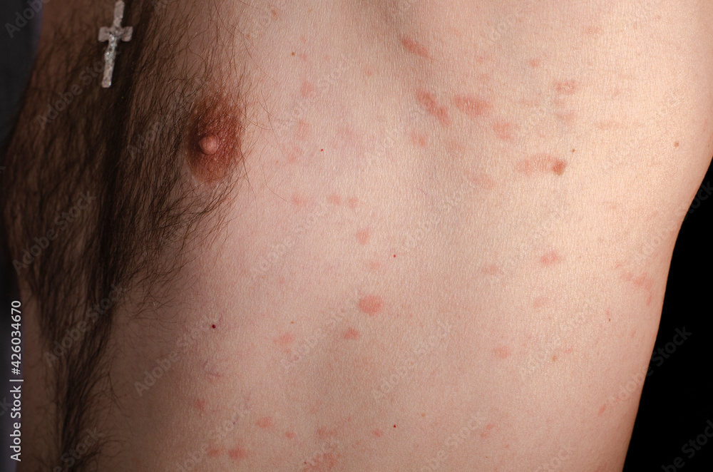 Pityriasis rosea is a type of skin rash Stock Photo | Adobe Stock