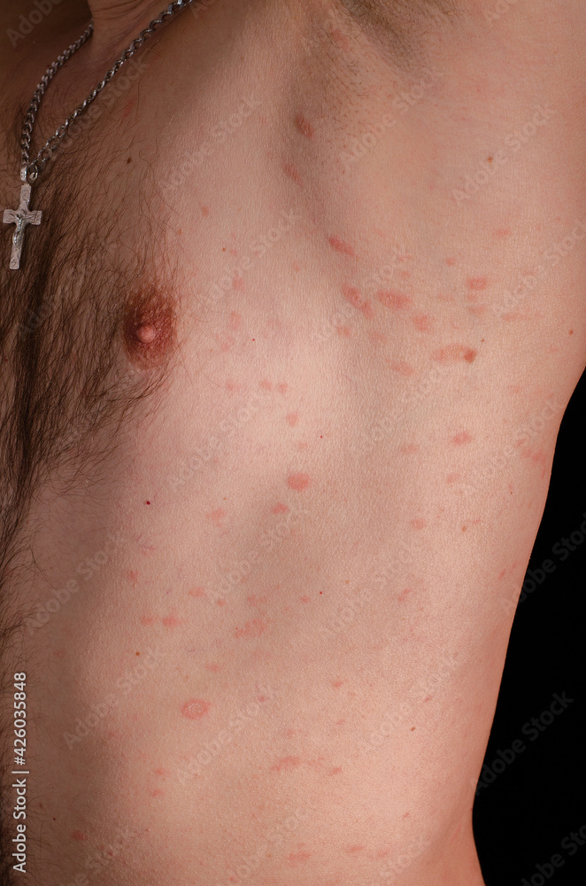 Pityriasis rosea is a type of skin rash Stock Photo | Adobe Stock