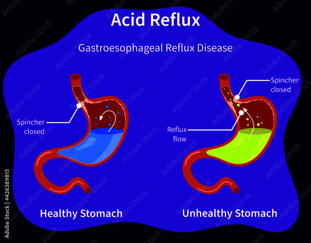 Acid reflux or gastroesophageal reflux, Heartburn. Gastric disease ...