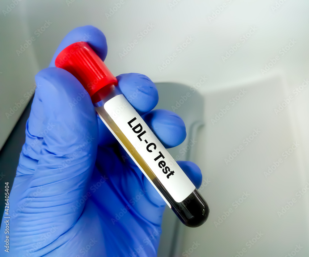 Blood sample for LDL-C (LDL cholesterol) test, Bad cholesterol, lipid ...