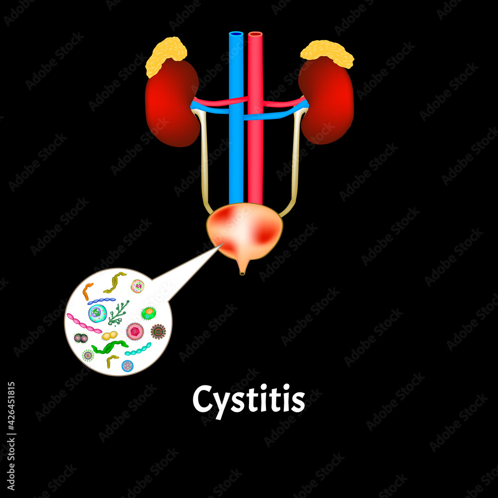 Cystitis. Inflammation of the bladder. The structure of the kidneys and ...