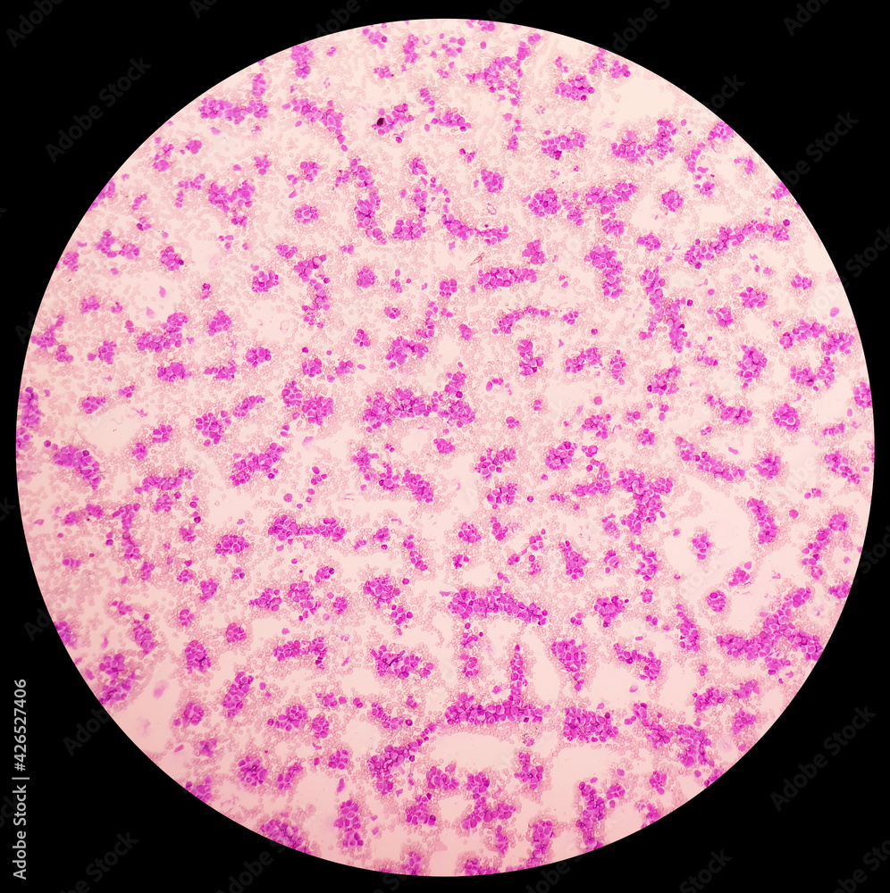 Chronic myeloid leukemia (CML) is a type of blood cancer. Microscopic ...