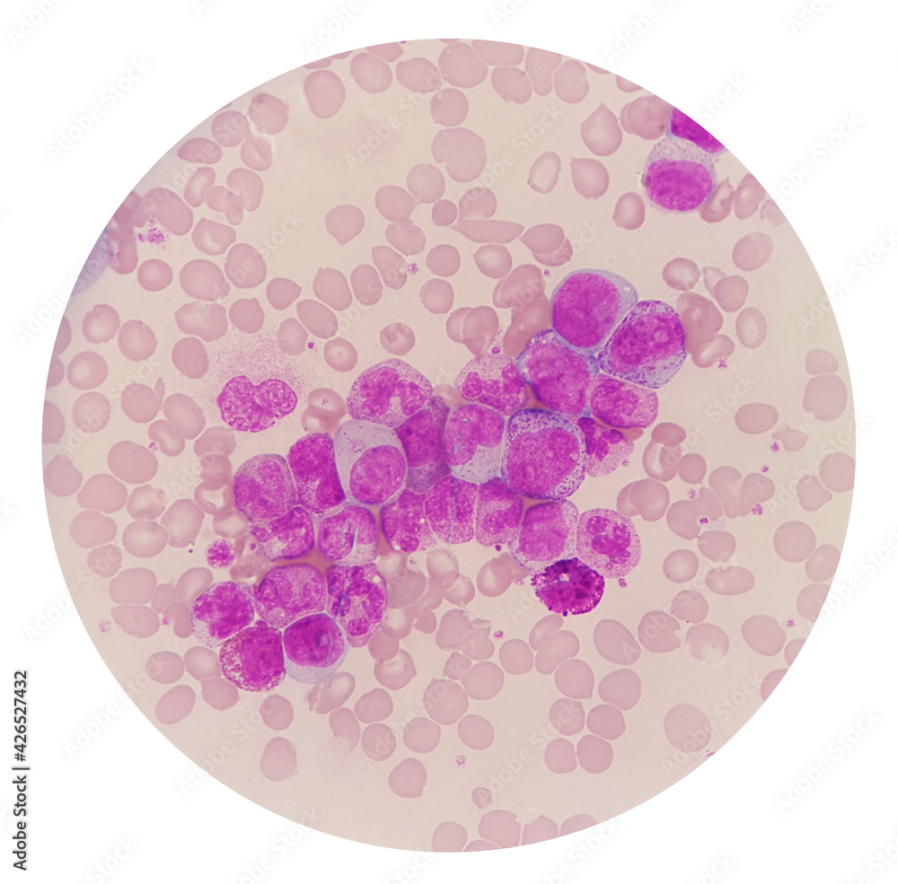 Chronic myeloid leukemia (CML) is a type of blood cancer. Microscopic ...