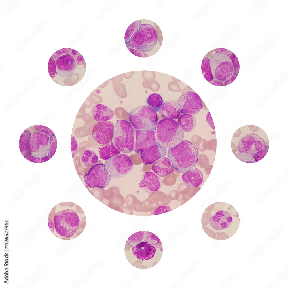 Chronic myeloid leukemia (CML) is a type of blood cancer. Microscopic ...