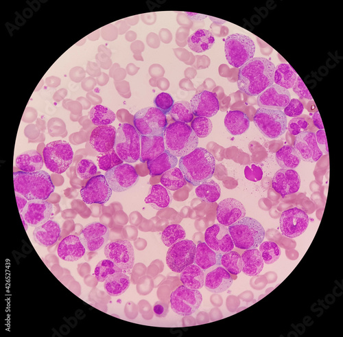 Chronic myeloid leukemia (CML) is a type of blood cancer. Microscopic ...