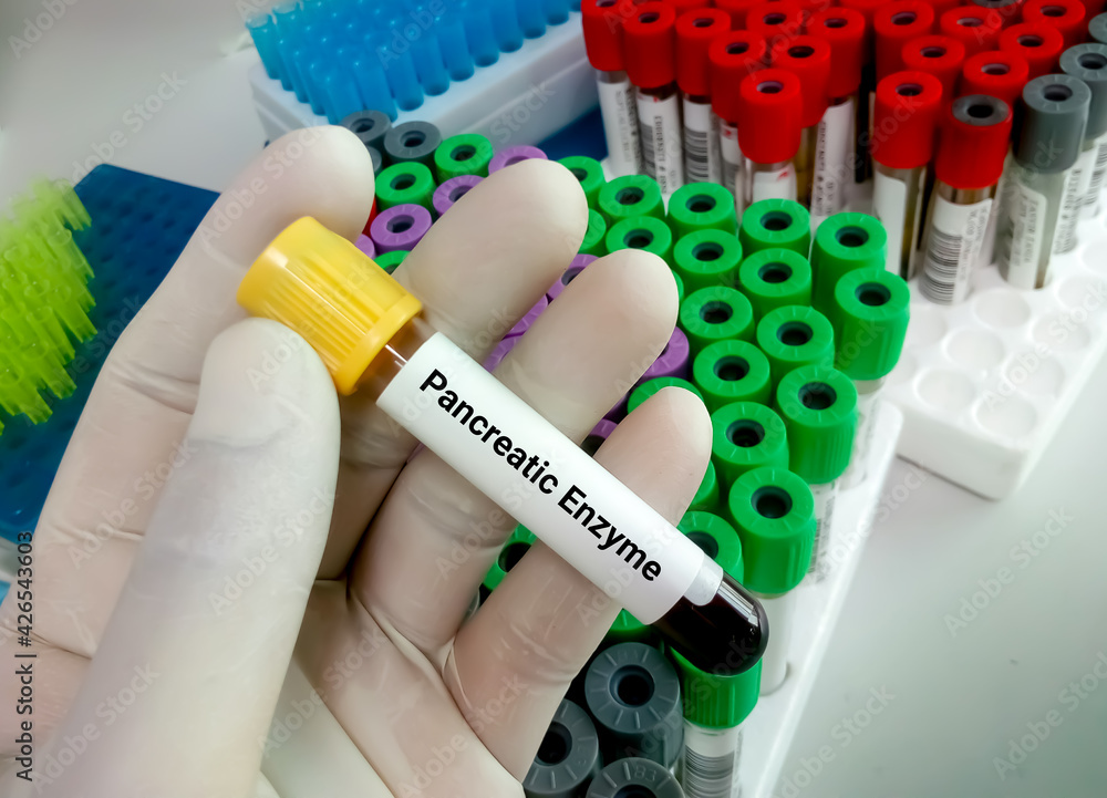 Test tube with blood sample for pancreatic enzyme test, amylase, lipase ...