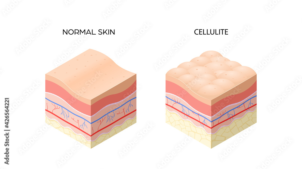 Poster skin with cellulite and normal skin cross-section of human skin ...