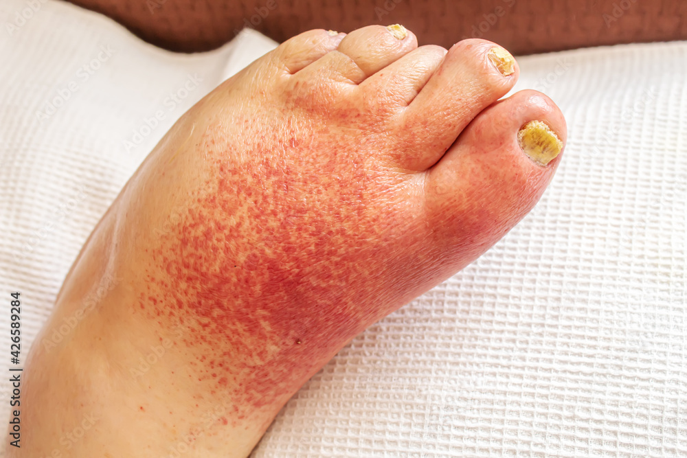 erysipelas of the legs, red rash on the legs.selective focus Stock 写真 ...