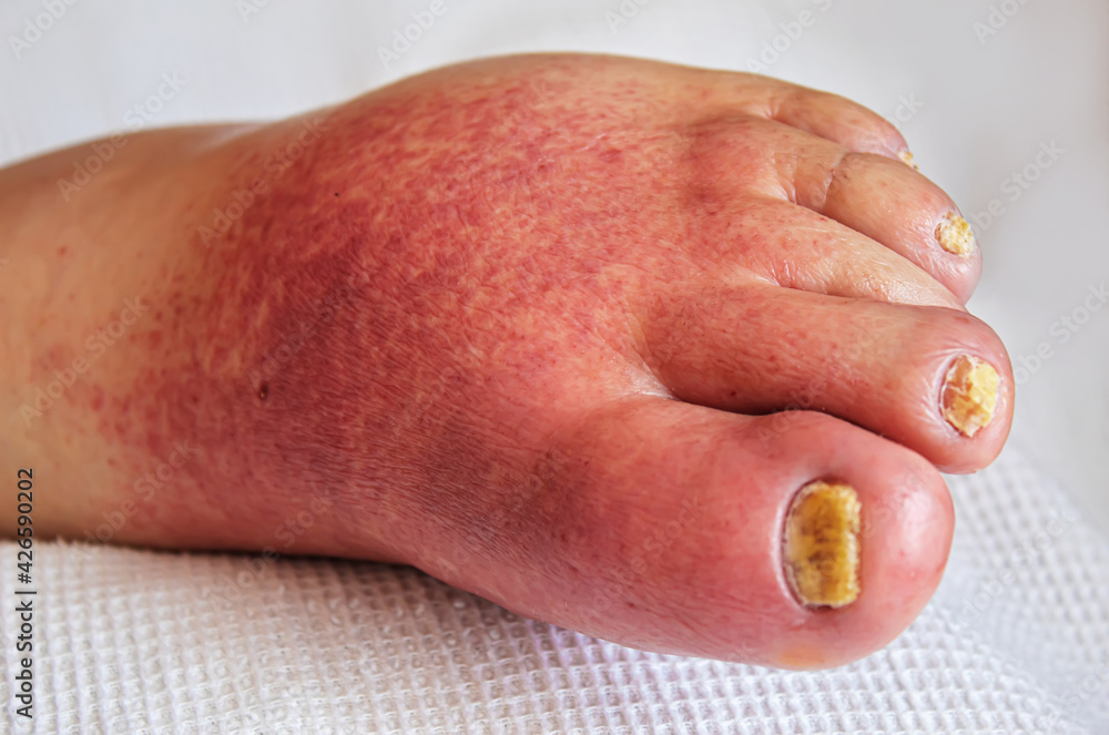 erysipelas of the legs, red rash on the legs.selective focus Photos ...