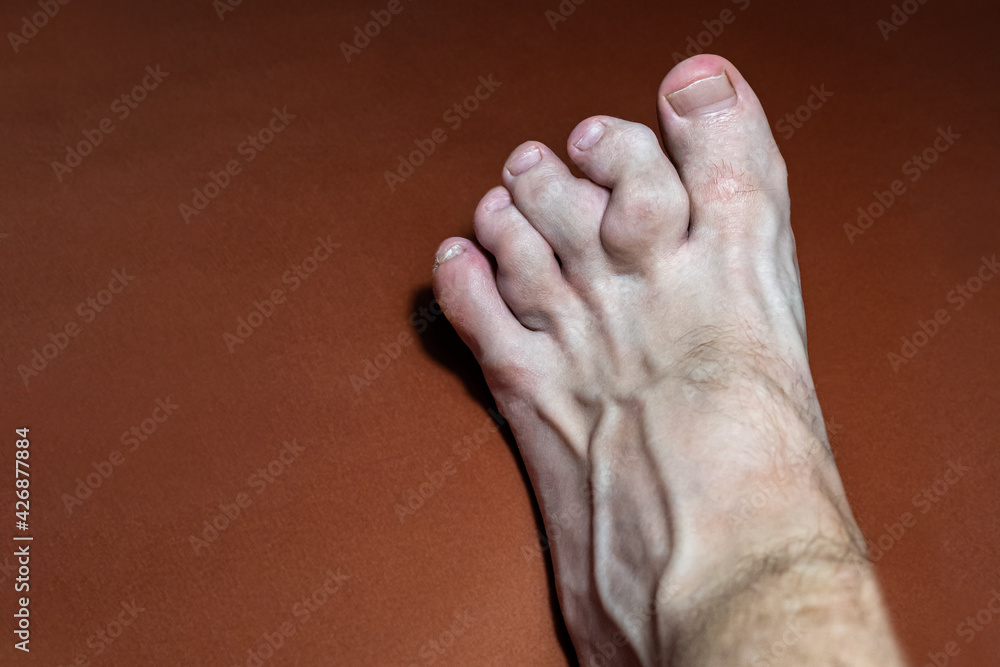 close-up of gouty toes. toes affected by Gout - a disease in which ...