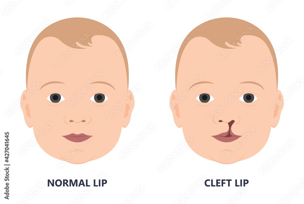 Cleft lip birth defect baby face nose Born gene drink bifid uvula roof ...