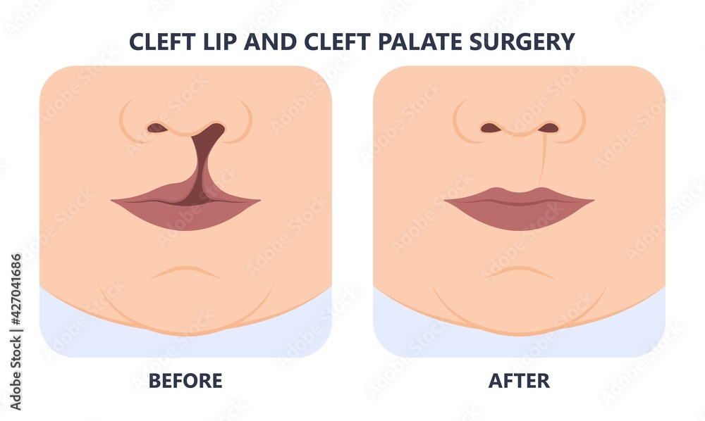 Cleft lip birth defect baby face nose Born gene drink bifid uvula roof ...