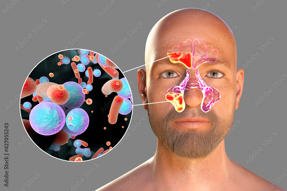 Purulent inflammation of frontal and maxillary sinuses in a man and ...