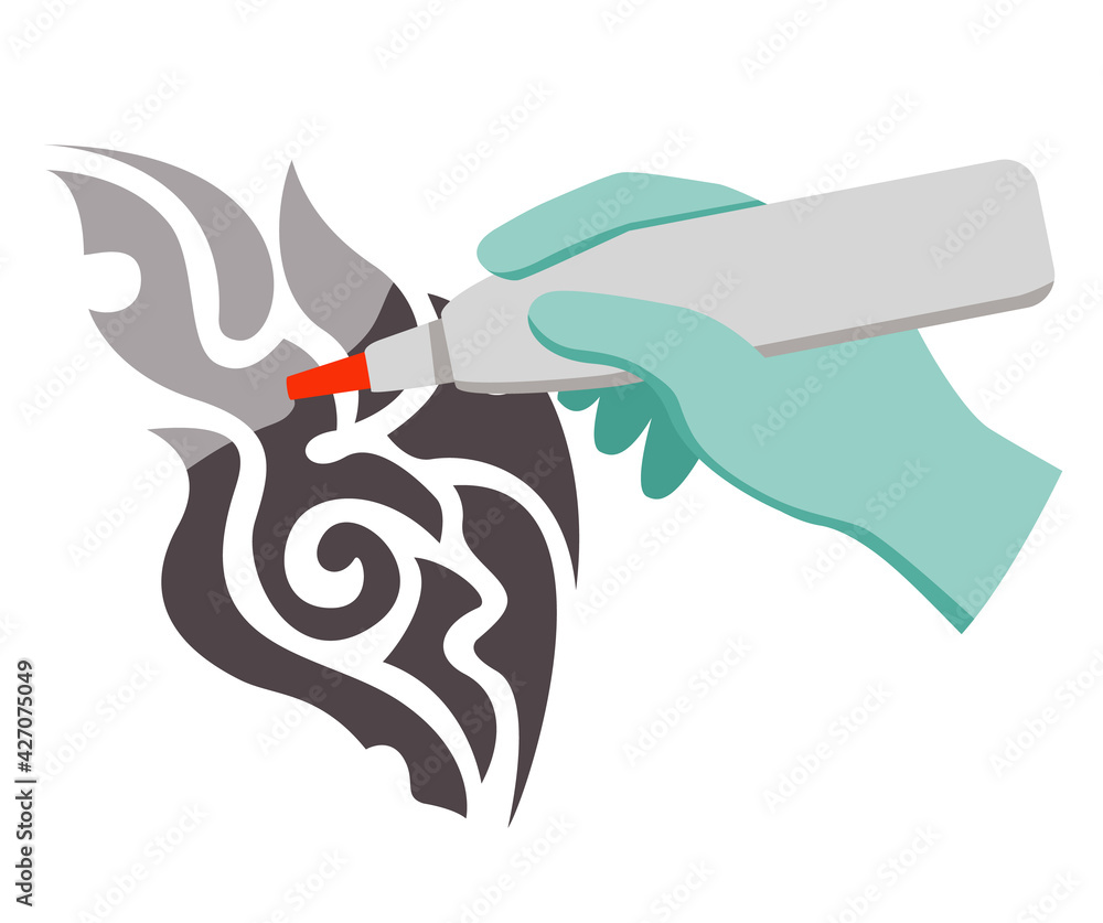 Laser tattoo removal.Removal procedure unwanted tattoos.Hand holds ...