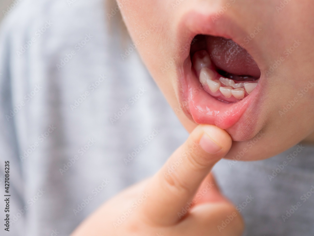 Little kid shows double row of teeth in his month. Molars grew before ...