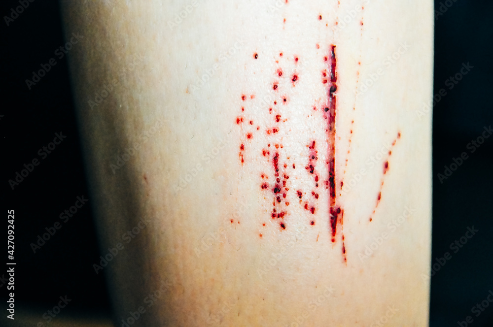 The wound form scabs. The wound happen during young man playing footbal ...