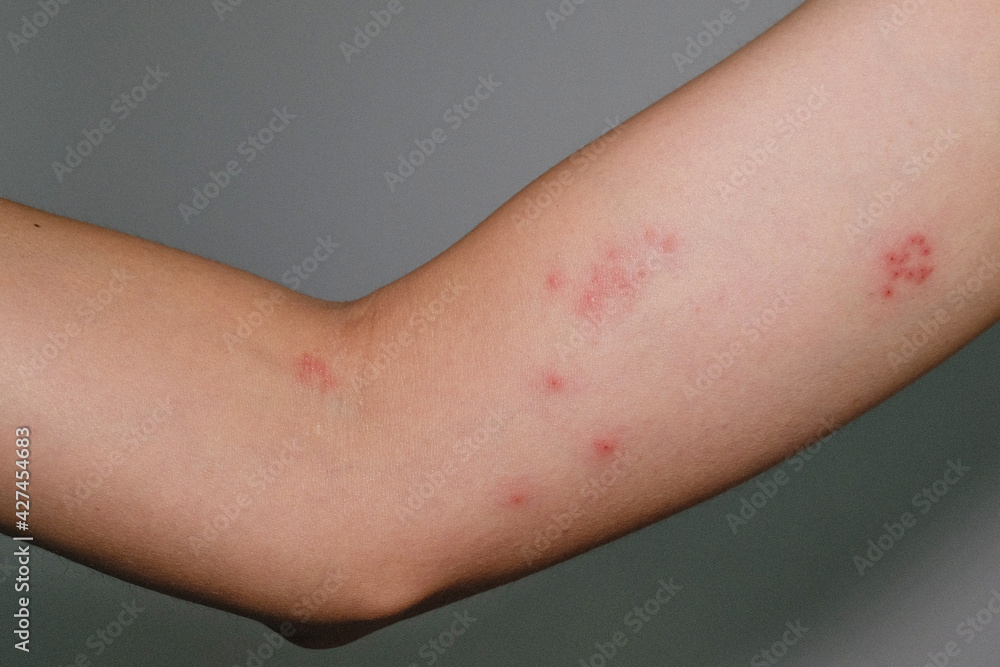 Shingles, Zoster or Herpes Zoster symptoms ,Wound is healed and starts ...