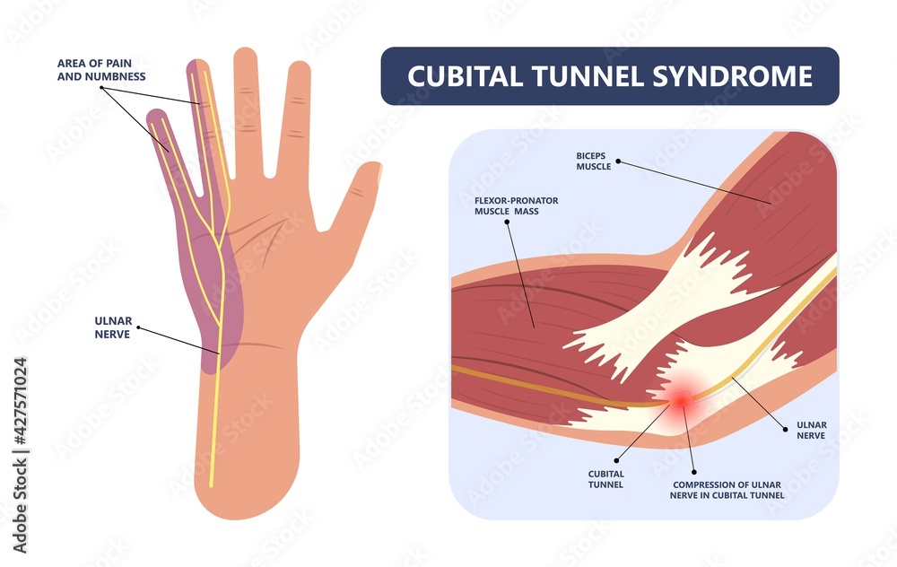 ulnar nerve muscle bone elbow swollen pain hand palm bone spurs ring ...