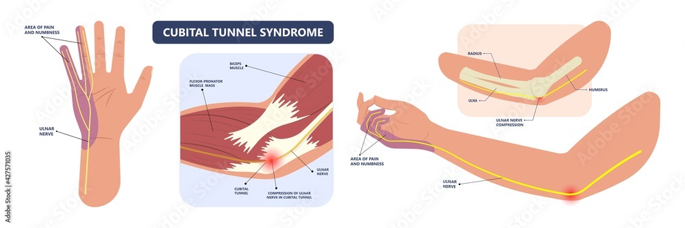 ulnar nerve muscle bone elbow swollen pain hand palm bone spurs ring ...