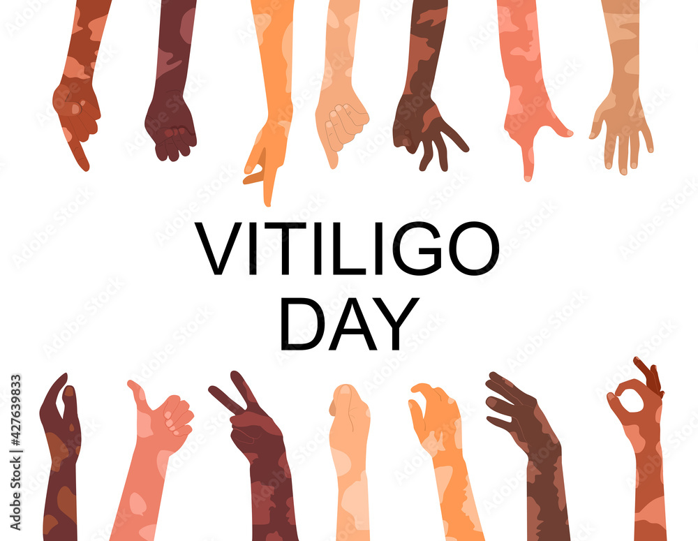 World vitiligo day poster.Hands different ethnicities in various ...