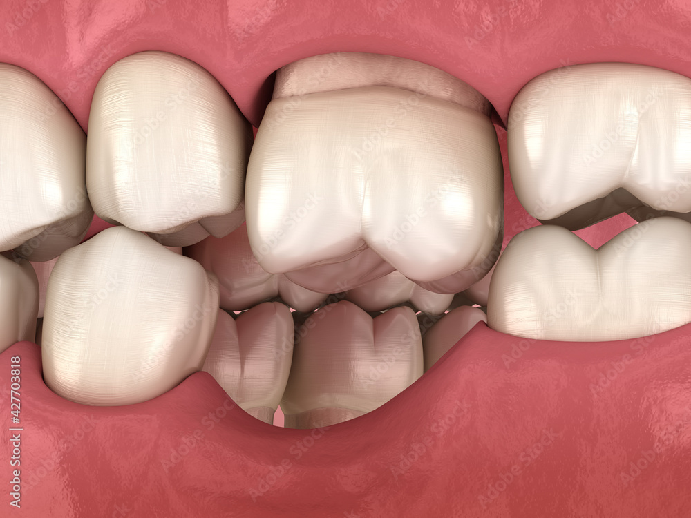 Teeth shift deformatiuon after losing molar tooth. 3D illustration of ...
