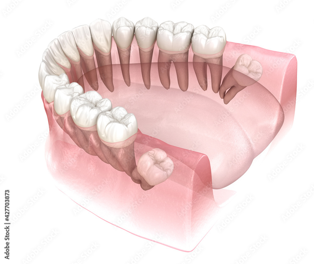Distal impaction of Wisdom tooth. Medically accurate tooth 3D ...