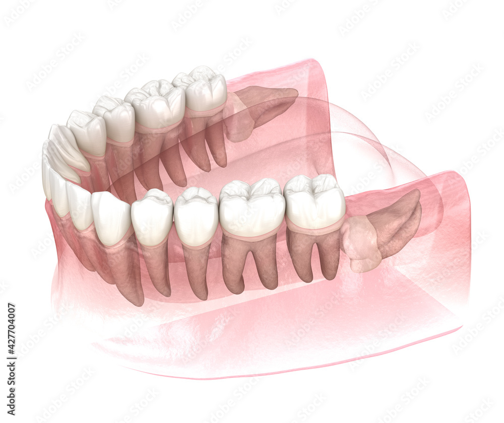Horizontal impaction of Wisdom tooth. Medically accurate tooth 3D ...