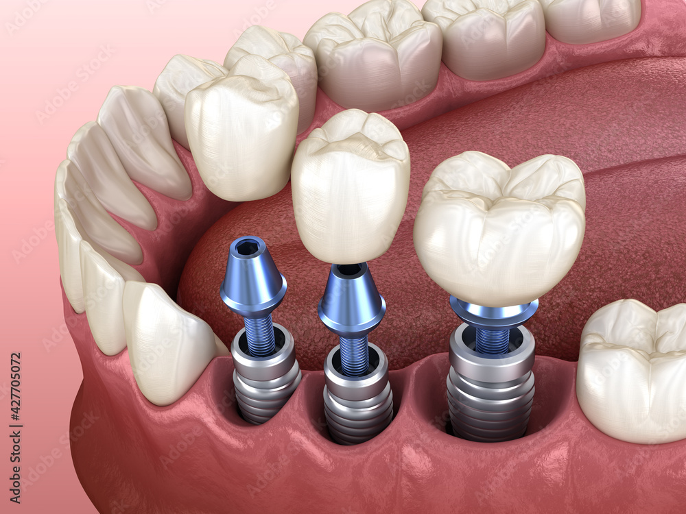 3 tooth crowns placement over 3 implants - concept. 3D illustration of ...