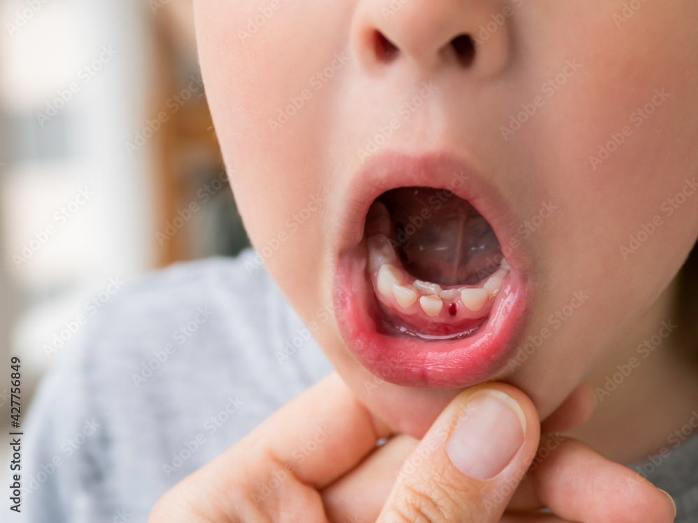 Little kid shows double row of teeth in his month. Molars grew before ...