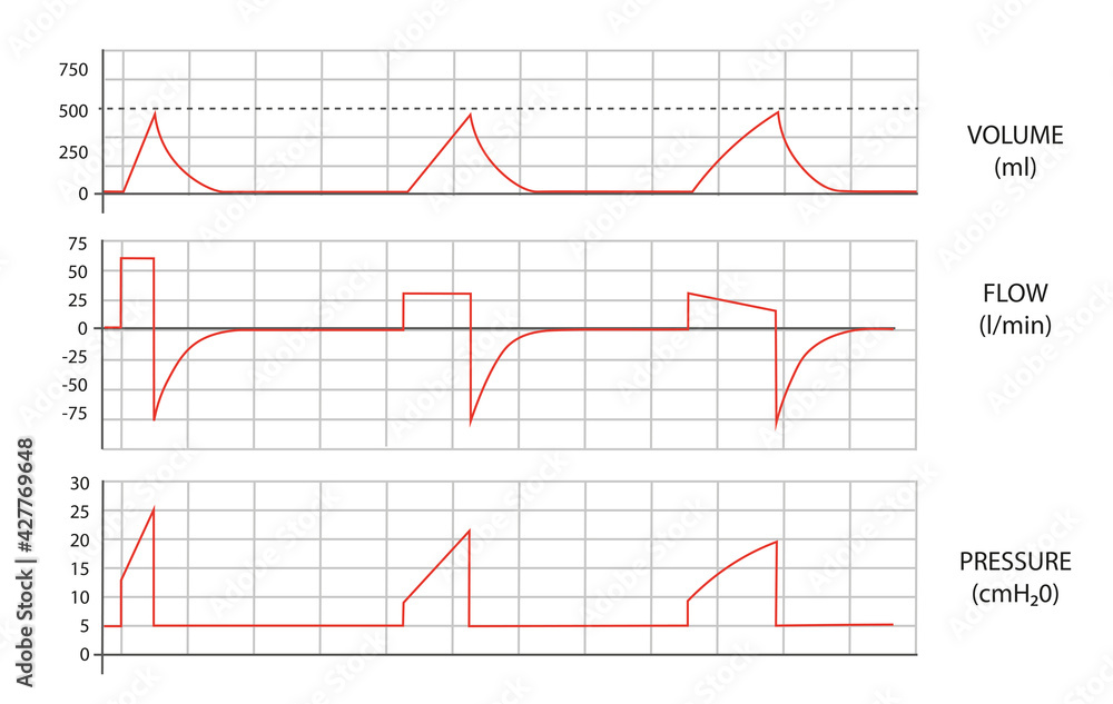 Mechanical Ventilation waves. Volume, flow and pressure curves from a ... Mechanical Ventilation waves. Volume, flow and pressure curves from a ...