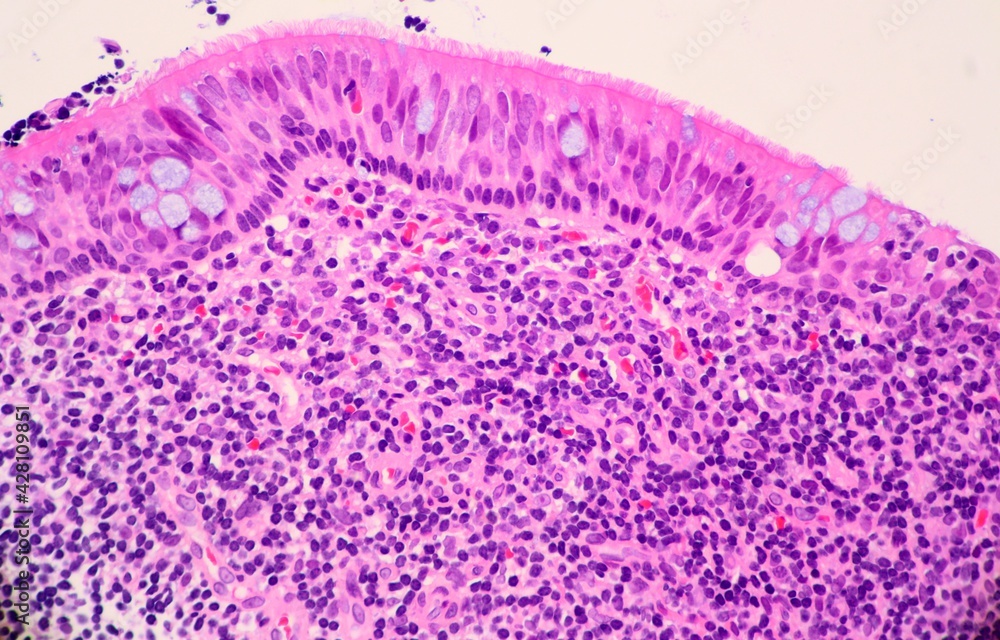 Hyperplastic tissue with lymphocytes lined by respiratory epithelium ...