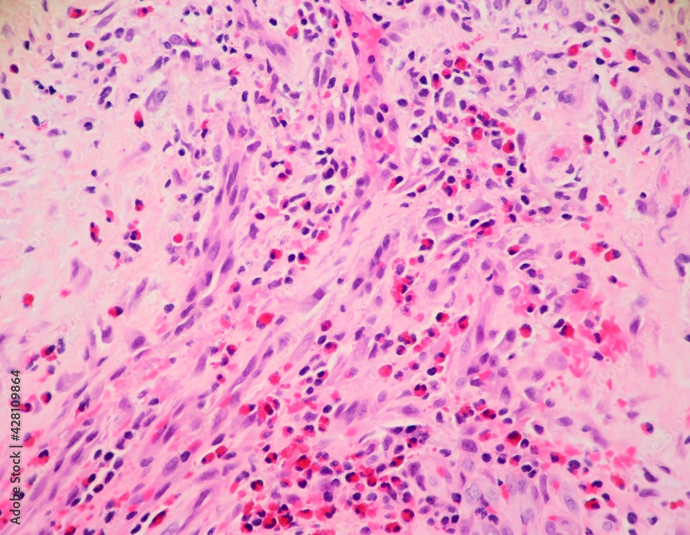 Vascular lesion known as angiolymphoid hyperplasia with eosinophilia ...