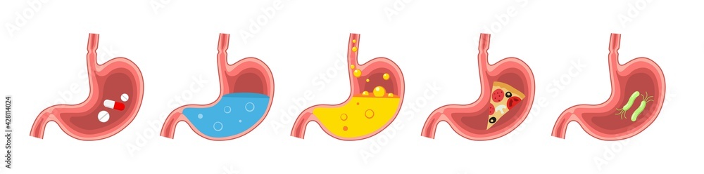 Set of healthy and sick stomach. Stomach pain, gastritis, indigestion ...