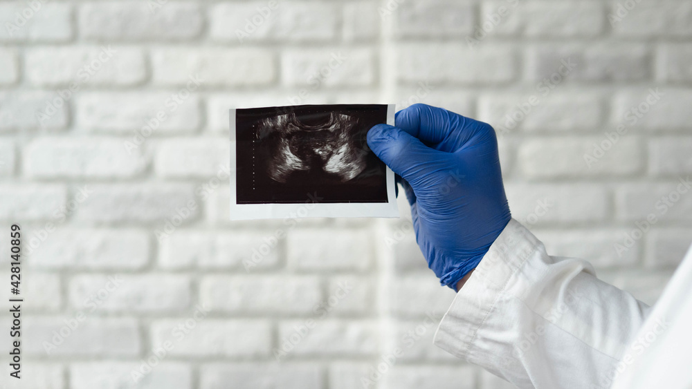 Doctor examines ultrasound images of the prostate gland, pictures of ...