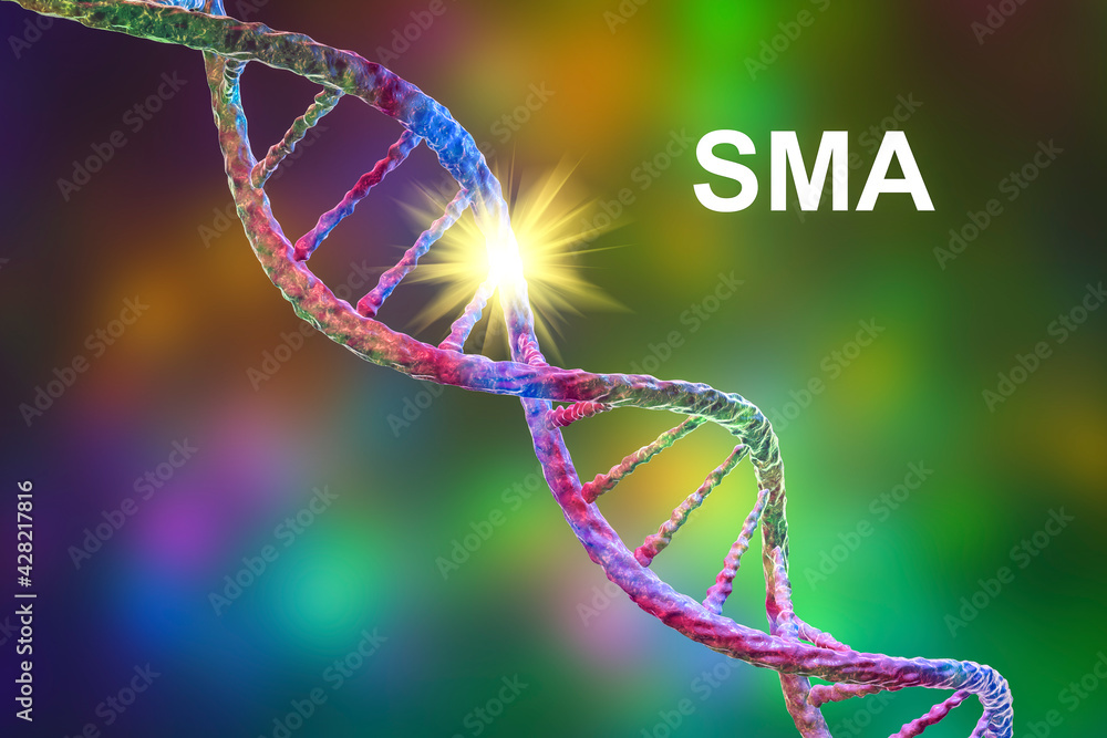 Spinal muscular atrophy, SMA, a genetic neuromuscular disorder Stock ...