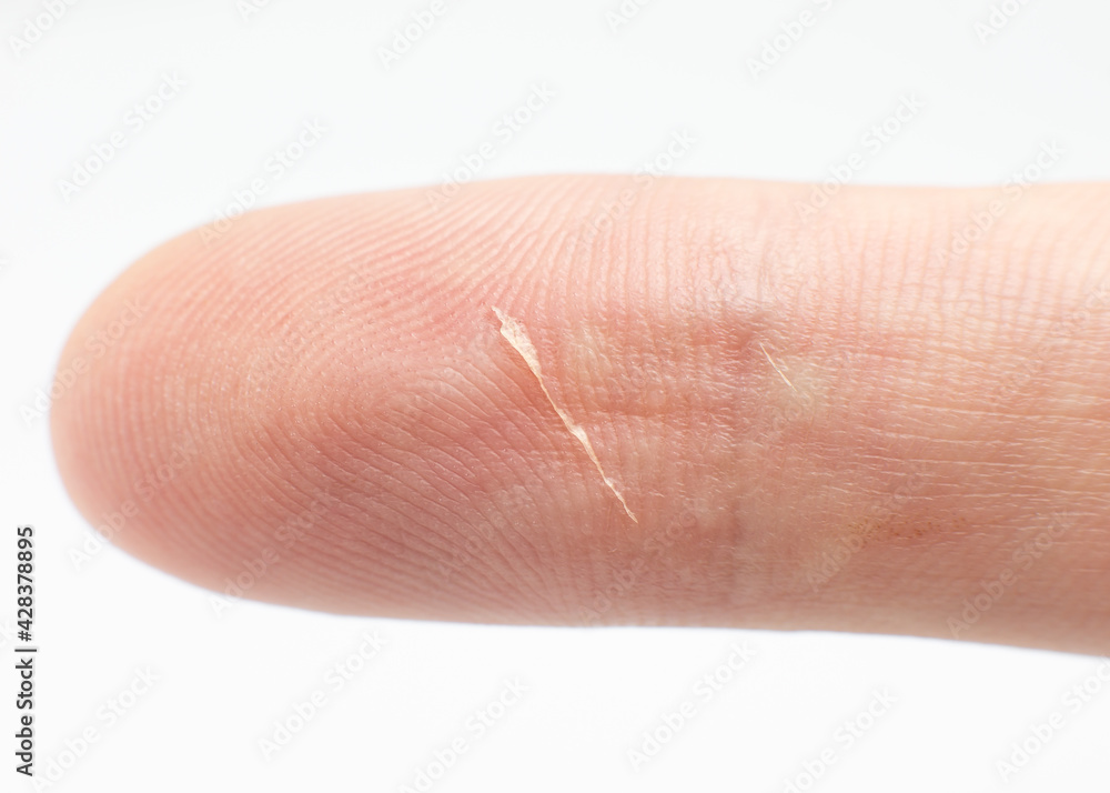 Cut on the finger.Human skin texture background. Macro photo, close up ...